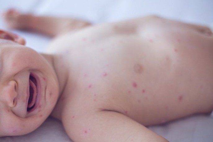 L’année de la rougeole – DAILY SCIENCE